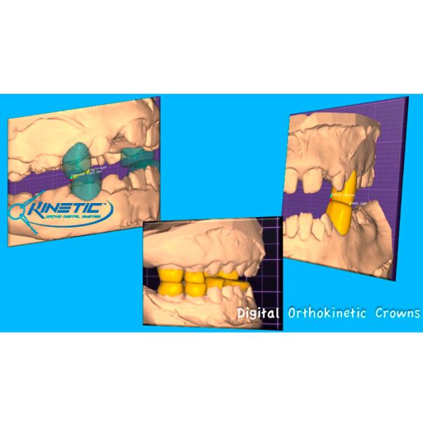 Digital Orthokinetics Crowns – Orthokinetic Apps